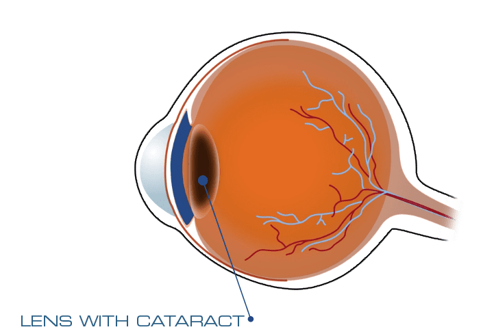 Advanced Cataract Surgery | Griffin Eye CenterYour #1 destination for ...